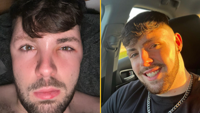 Man who ignored 'no sex' advice after hair transplant instantly regrets it